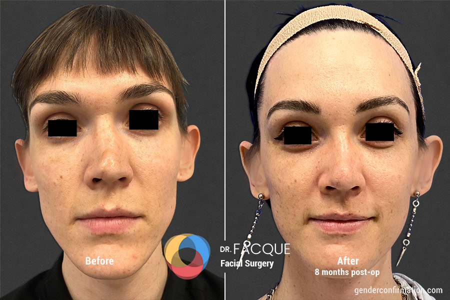 Facial Feminization Surgery - Gender Confirmation