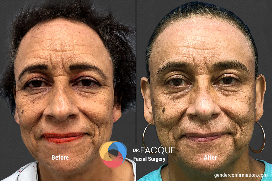 Facial Feminization Surgery - Gender Confirmation